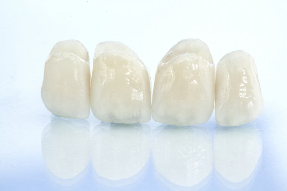 Porcelain Crowns, Porcelain Bridge, Crown On Implants.